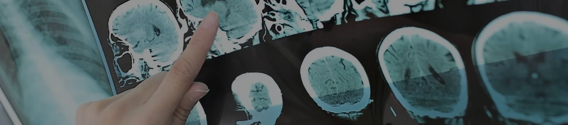 Ischemic Stroke: Causes, Symptoms and Treatment